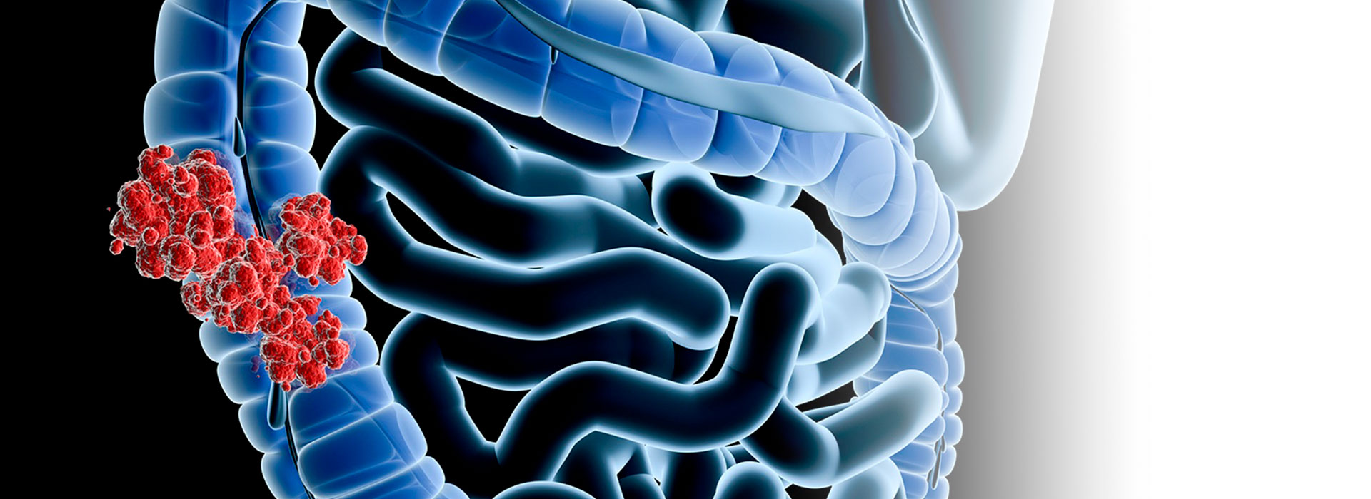 Colectomías - Dr. Eduardo Sotelo