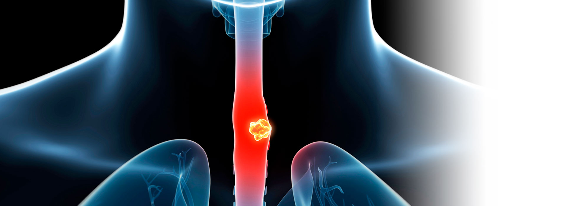 Esofagectomías - Dr. Eduardo Sotelo