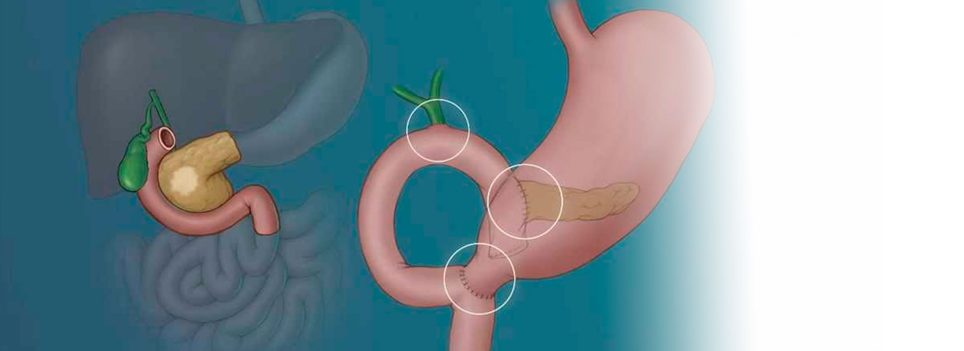 Cirugía de whipple (GRANDES) - Dr. Eduardo Sotelo